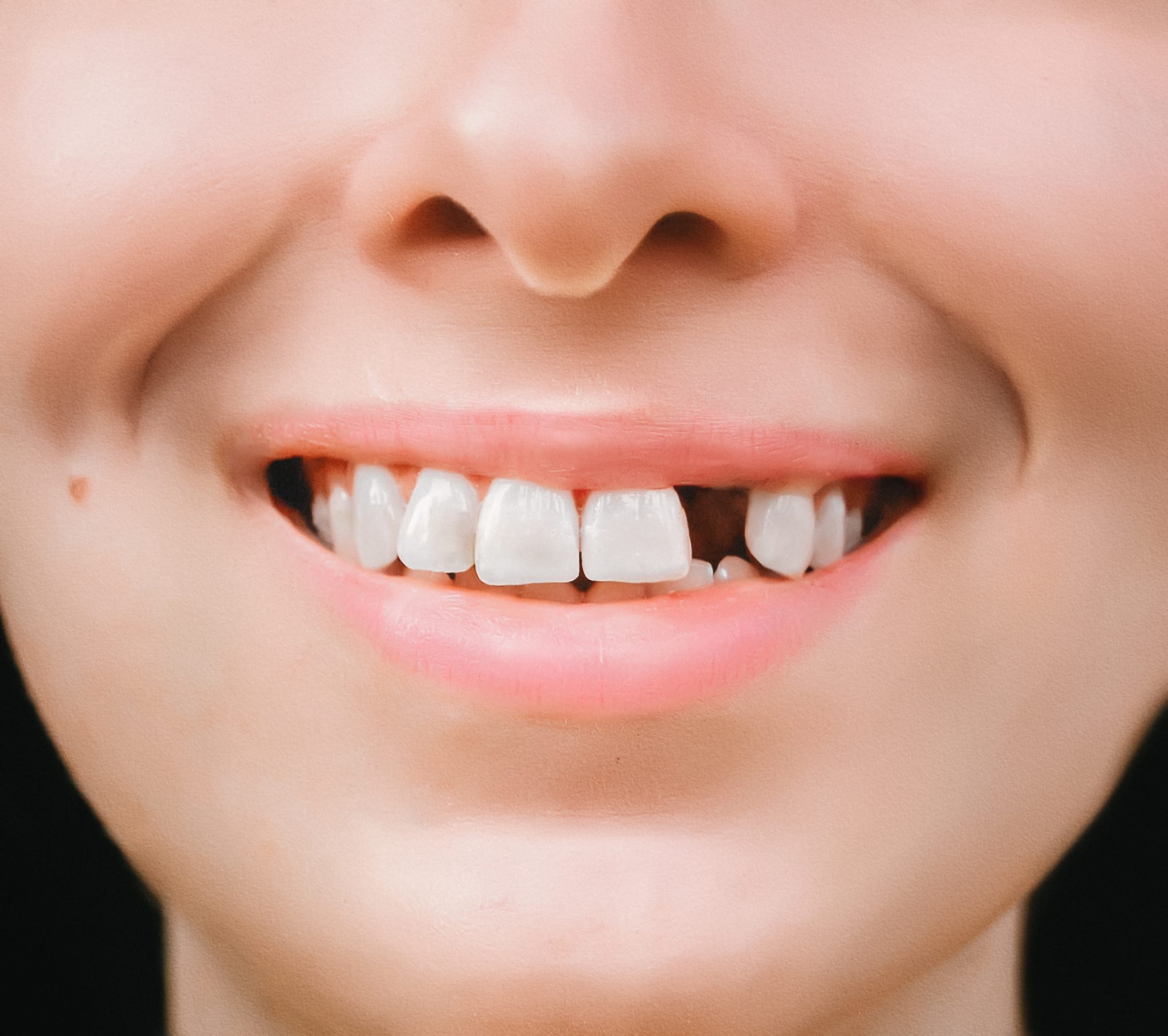 How Should I Handle Losing a Tooth in Maple Grove? | Maple Grove, MN